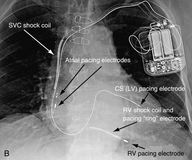 دفیبریلاتور کاشتنی قلبی = AICD/ICD